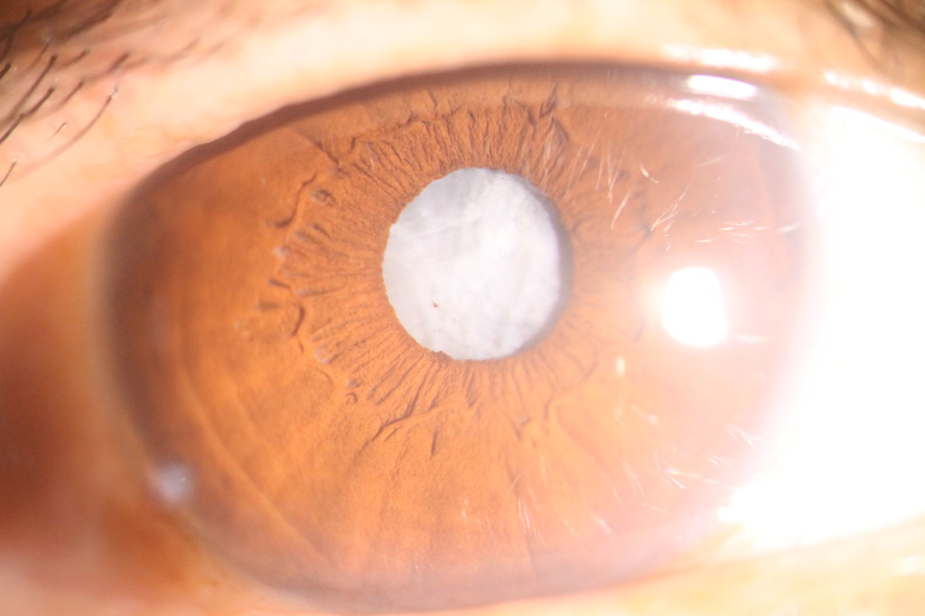 Hoy la Oftalmologia ofrece mejores resultados a enfermos de Catarata ...